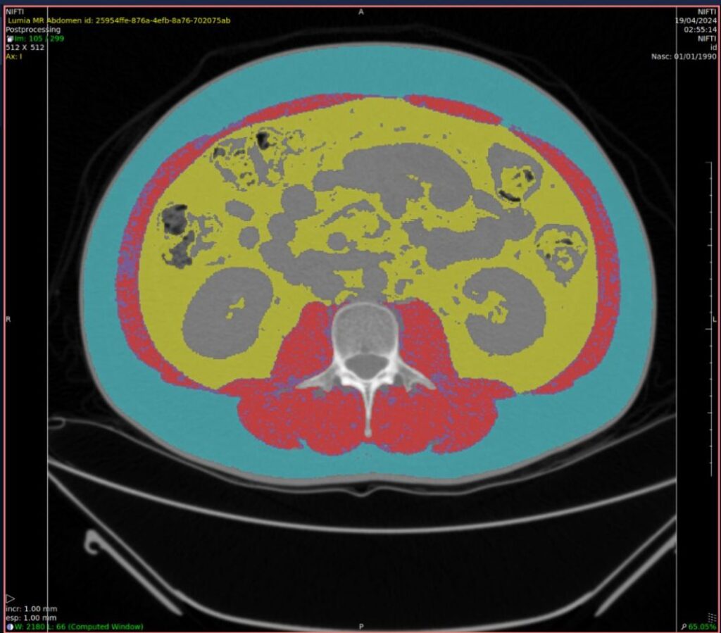 Inteligência Artificial na radiologia: exemplos de IA na saúde