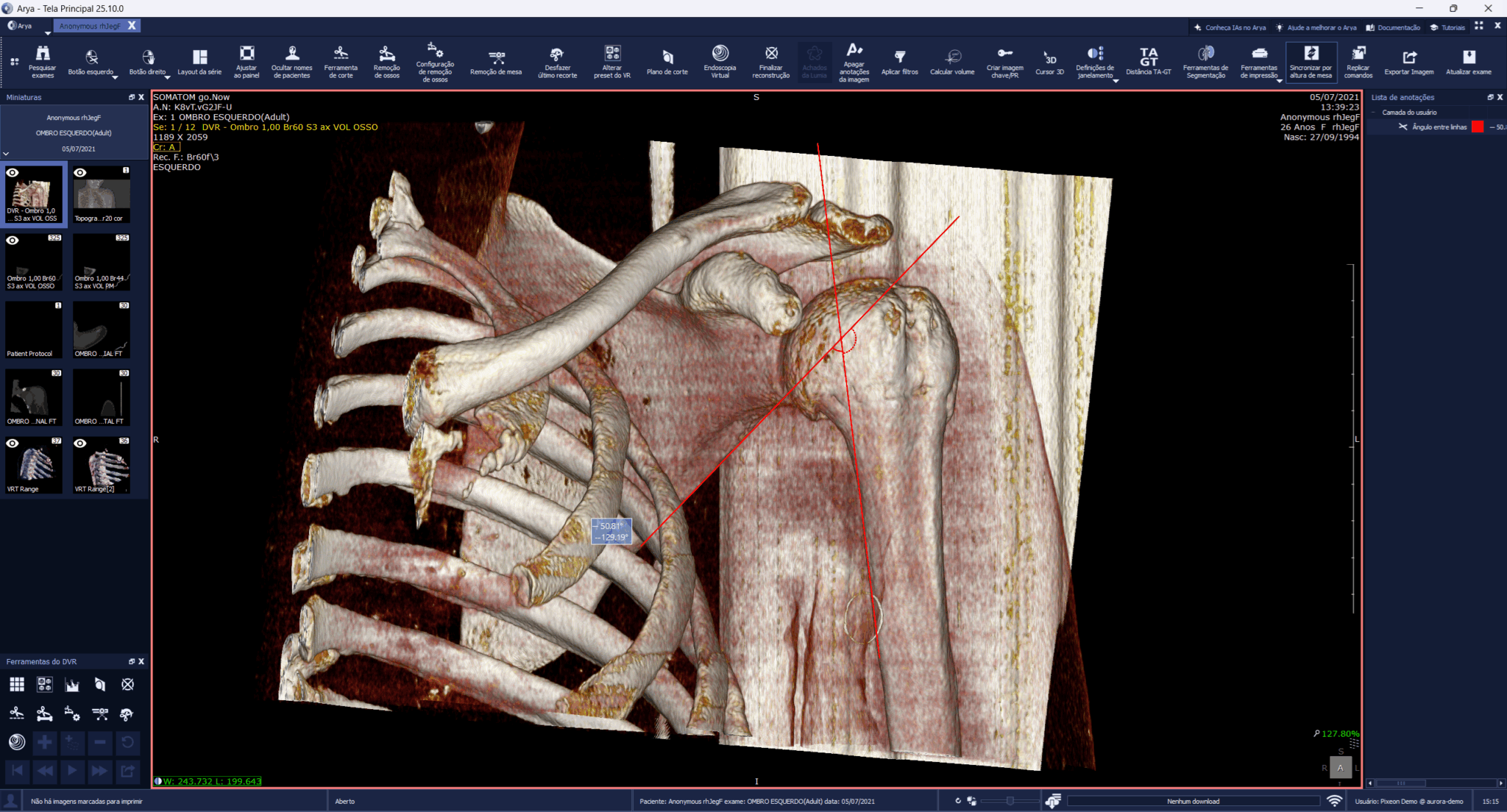New Angle Measurement Feature for Orthopedics Now Available in the ...